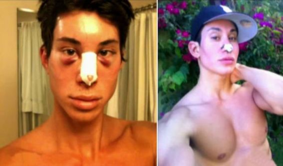 Justin Jedlica, el "Ken" humano con 90 cirugías estéticas